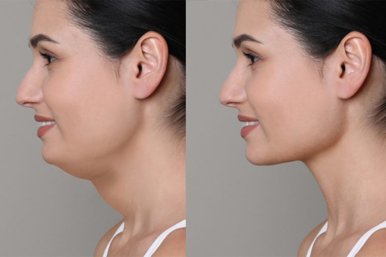 Everything You Need To Know About Double Chin Treatment - Aarogya ...